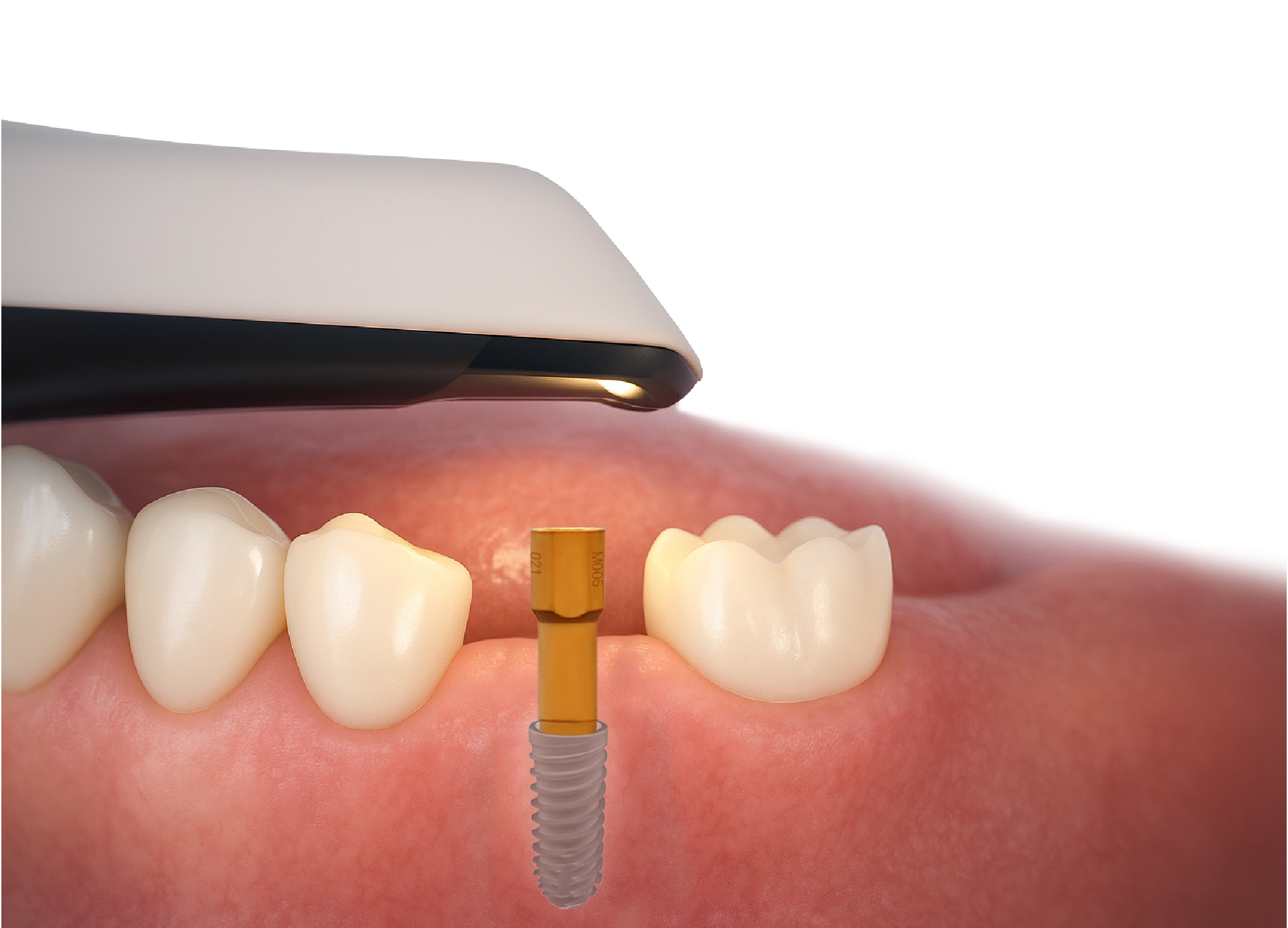 Hoil Scanbody - HOIL DENTAL